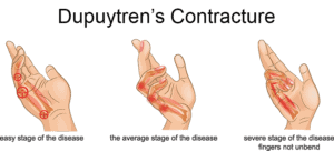 Dupuytren’s Contracture | FORM Hand, Wrist & Elbow Institute