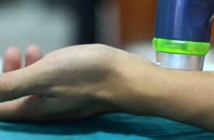 Hand Therapy | FORM Hand, Wrist & Elbow Institute