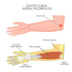 Golfer’s Elbow Causes & Treatment | FORM Hand, Wrist & Elbow Institute